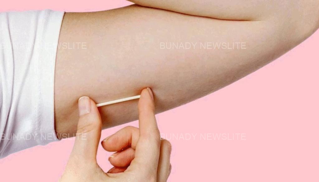 Side Effects of Contraceptive Implant That You Need To Know - Bunady